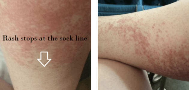 The Disney Rash: What It Is and How To Treat It